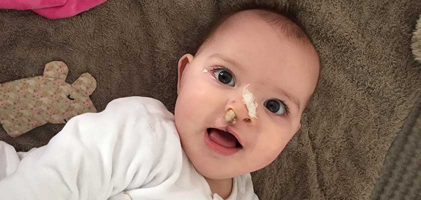 Een kindje met een schisis - deel 3: de eerste operatie